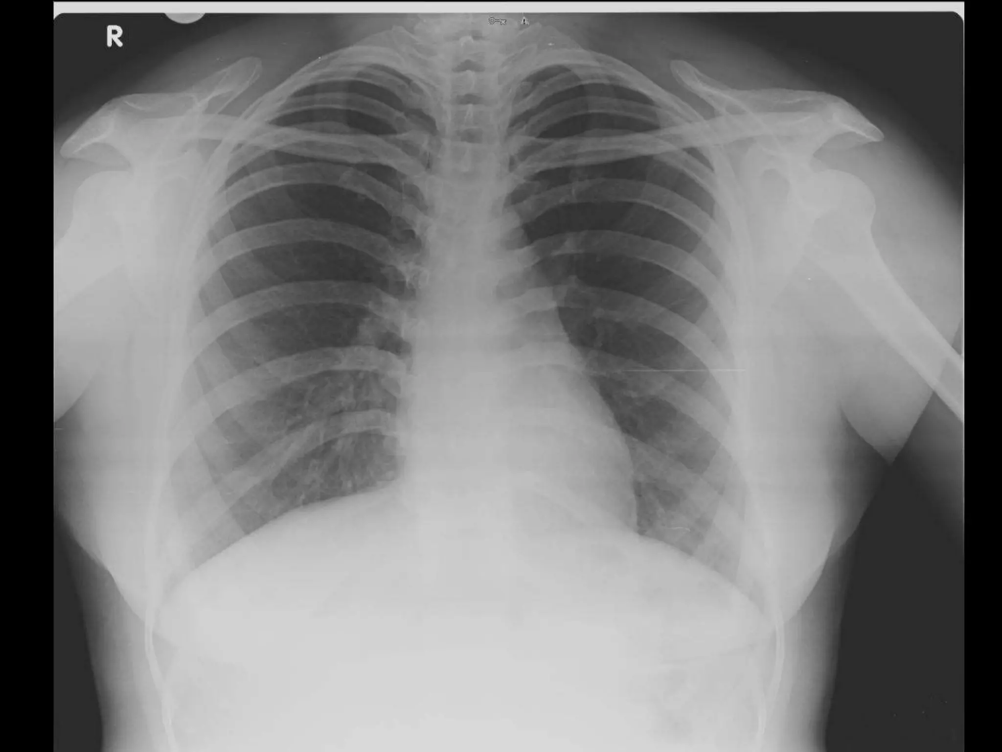 Interpretation of x ray in disease process | PPT