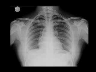Interpretation of x ray in disease process | PPTX