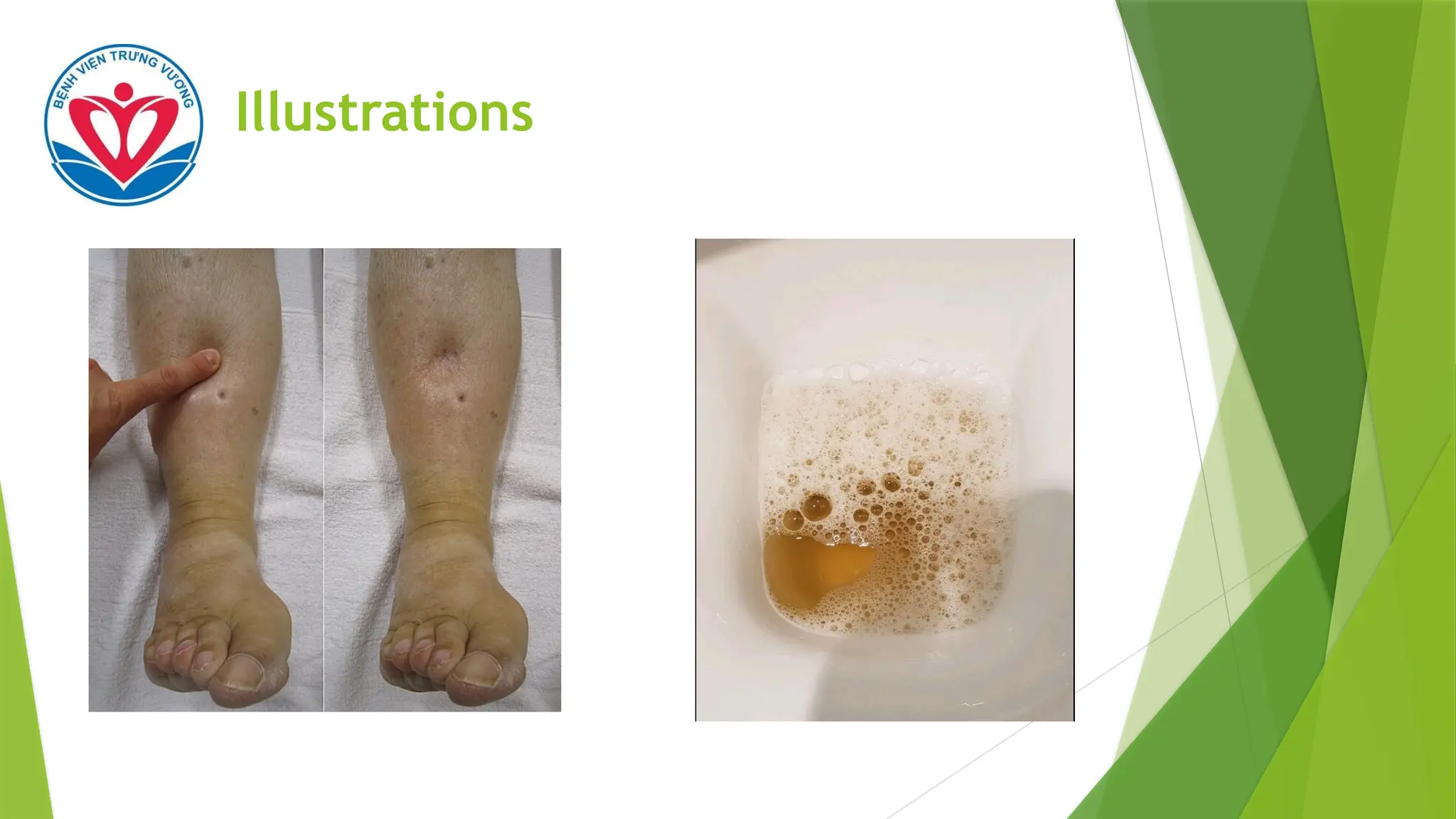 Interpretation a general urinalysis in a clinical case.pptx