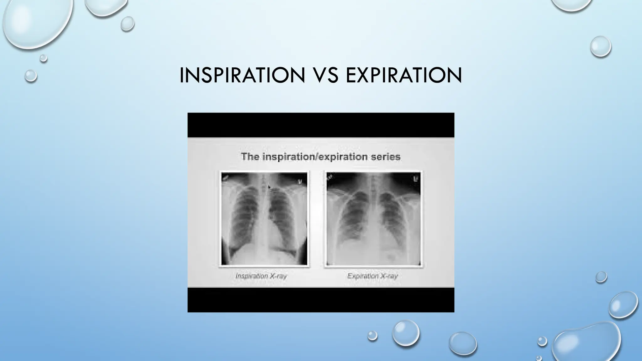 Interpretation of anatomy of chest x-ray and ct-chest.pptx