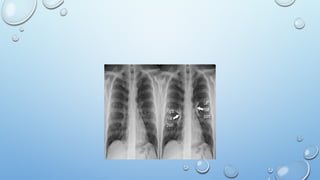 Interpretation of anatomy of chest x-ray and ct-chest.pptx