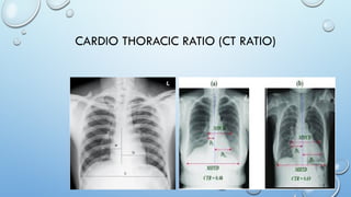 Interpretation of anatomy of chest x-ray and ct-chest.pptx