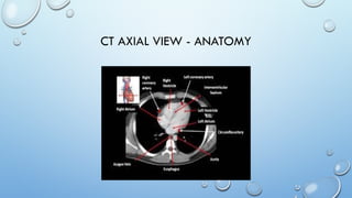 Interpretation of anatomy of chest x-ray and ct-chest.pptx