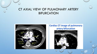 Interpretation of anatomy of chest x-ray and ct-chest.pptx