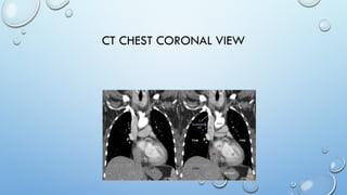 Interpretation of anatomy of chest x-ray and ct-chest.pptx