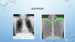 Interpretation of anatomy of chest x-ray and ct-chest.pptx