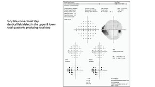 INTERPRETATION OF AUTOMATED PERIMETRY.pptx