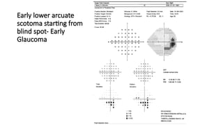 INTERPRETATION OF AUTOMATED PERIMETRY.pptx