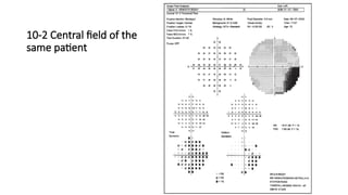 INTERPRETATION OF AUTOMATED PERIMETRY.pptx