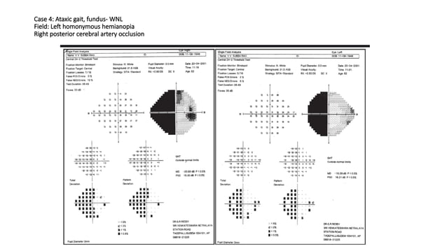 INTERPRETATION OF AUTOMATED PERIMETRY.pptx