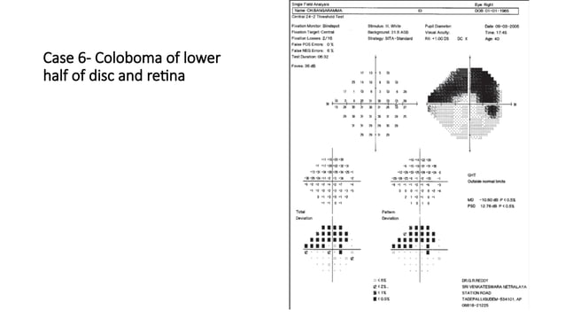 INTERPRETATION OF AUTOMATED PERIMETRY.pptx
