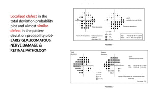 INTERPRETATION OF AUTOMATED PERIMETRY.pptx