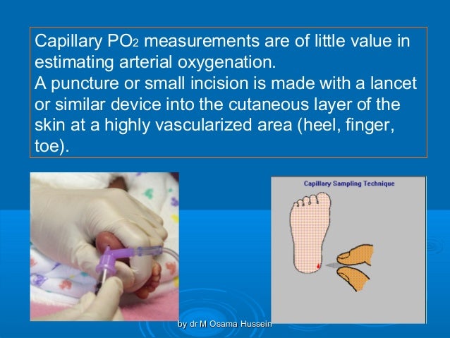 Interpretation of blood gases