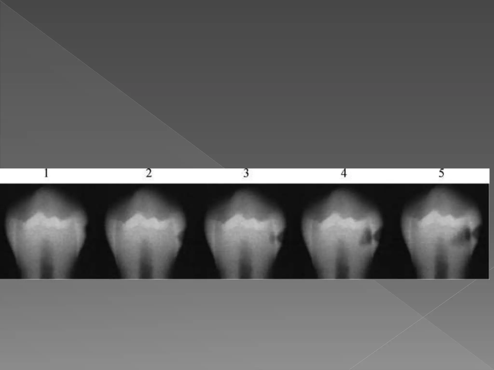 Interpretation of caries_and_periodontitis (Dr RAJ AC) | PPT