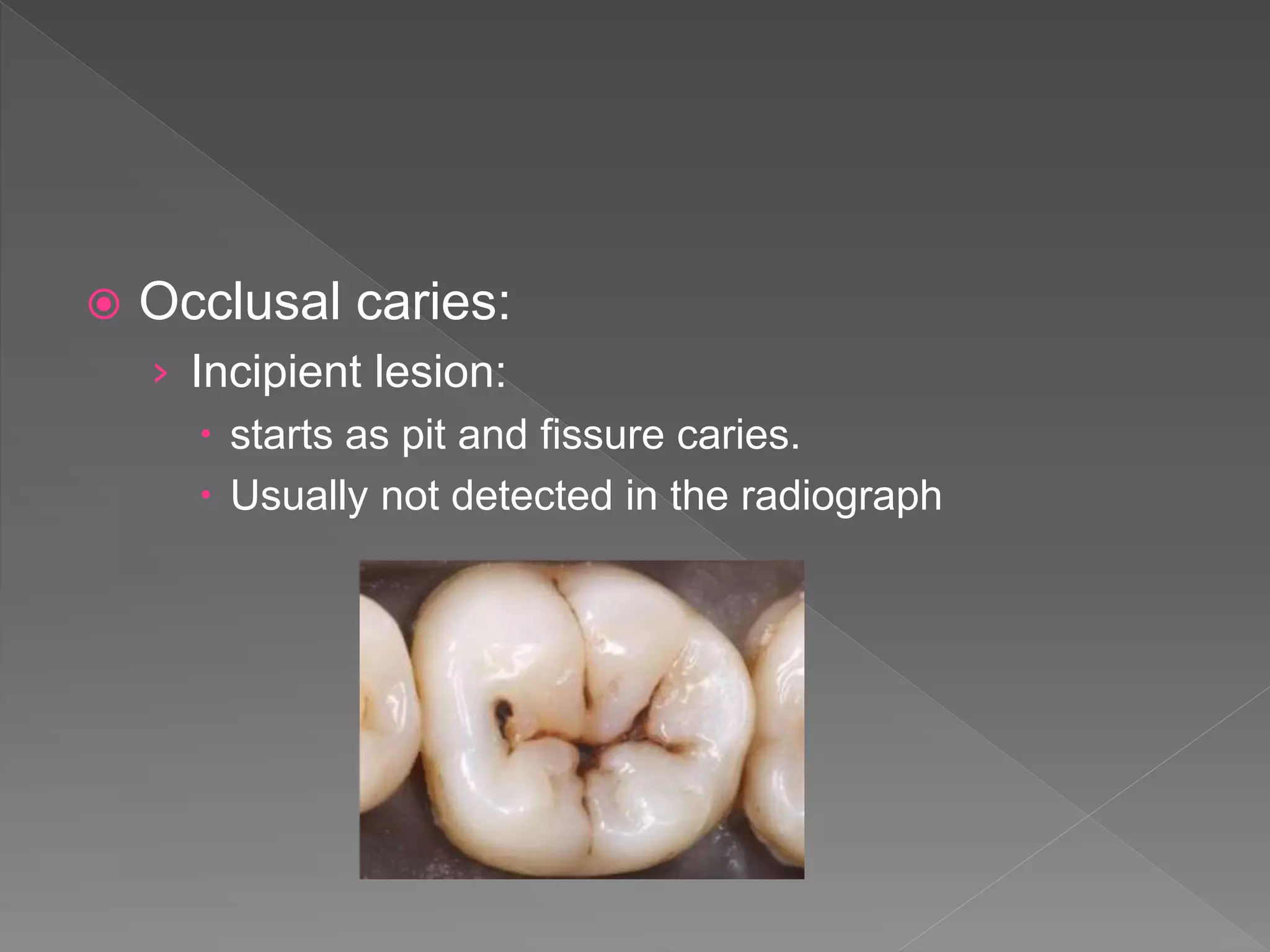 Interpretation of caries_and_periodontitis (Dr RAJ AC) | PPT