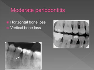 Interpretation of caries_and_periodontitis (Dr RAJ AC) | PPT