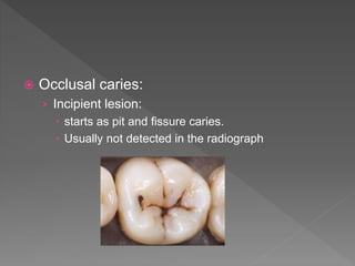 Interpretation of caries_and_periodontitis (Dr RAJ AC) | PPT