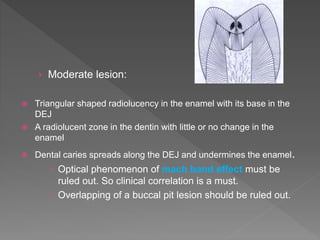Interpretation of caries_and_periodontitis (Dr RAJ AC) | PPSX