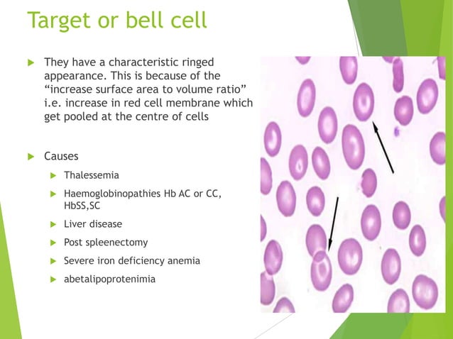 Interpretation of cbc | PPTX | Blood Disorders | Diseases and Conditions