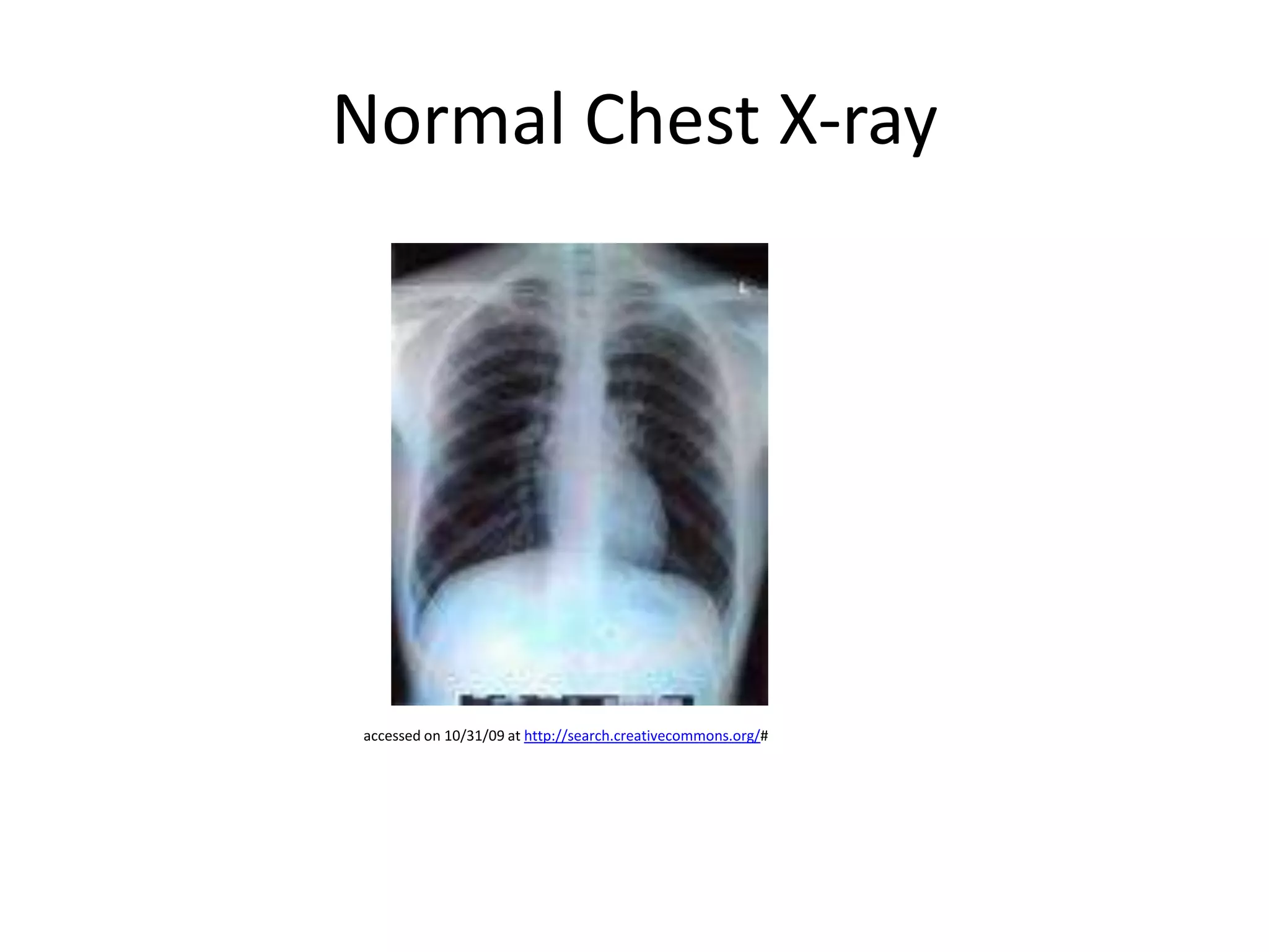 Interpretation Of Chest X Rays | PPTX