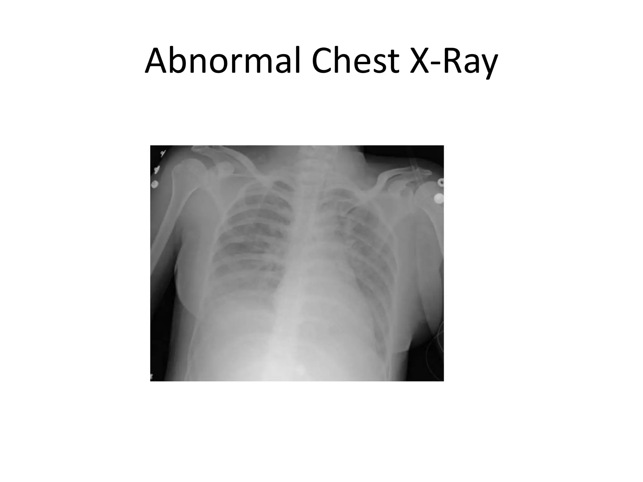 Interpretation Of Chest X Rays | PPTX