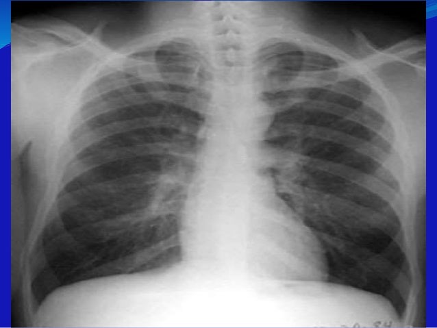 Interpretation of chest x ray