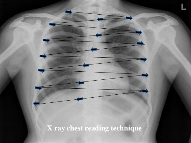 Kyphosis Ainsworth Institute