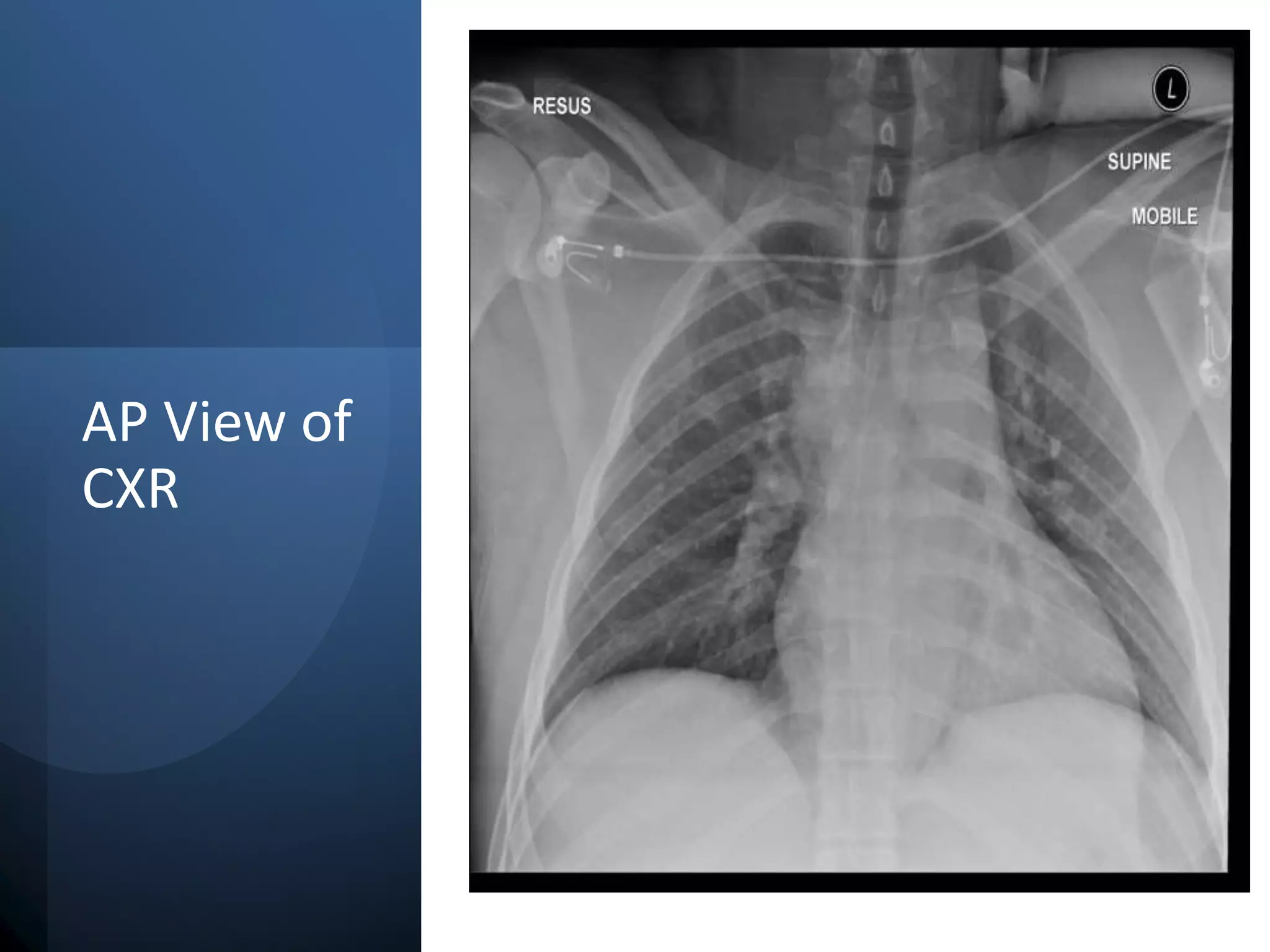 Interpretation of chest xray ppt | PPTX