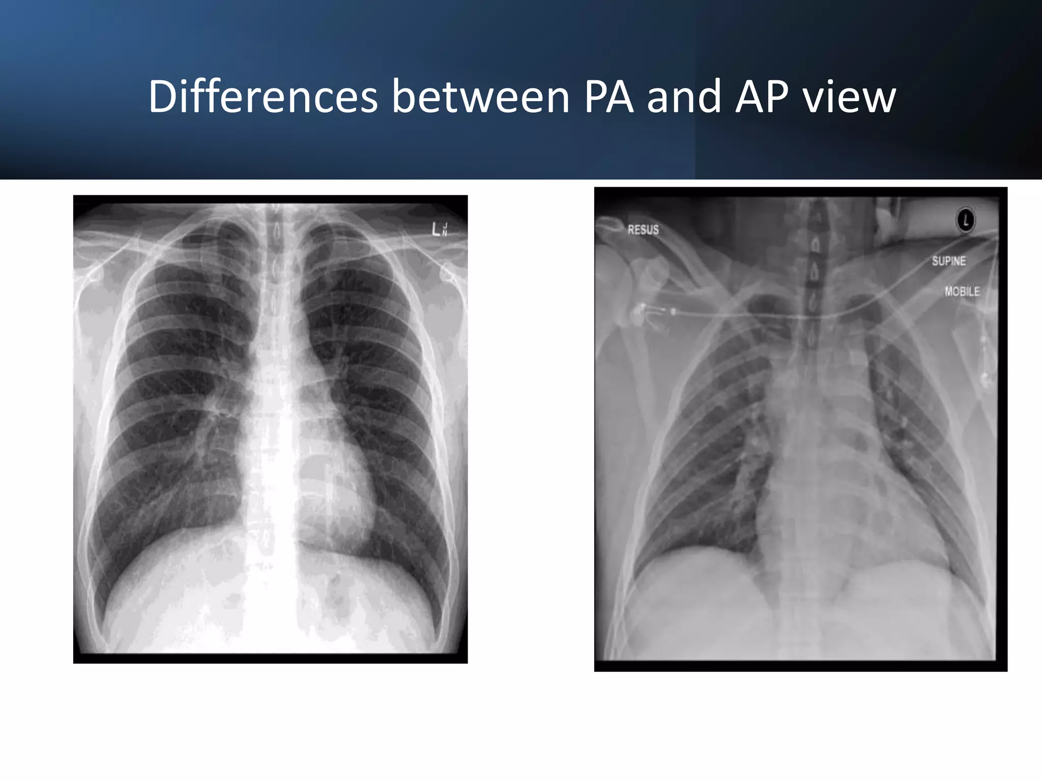 Interpretation of chest xray ppt | PPTX