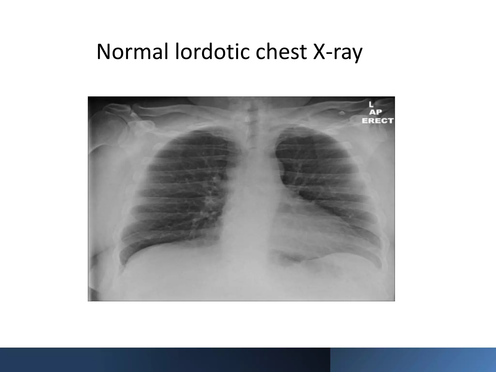 Interpretation of chest xray ppt | PPTX