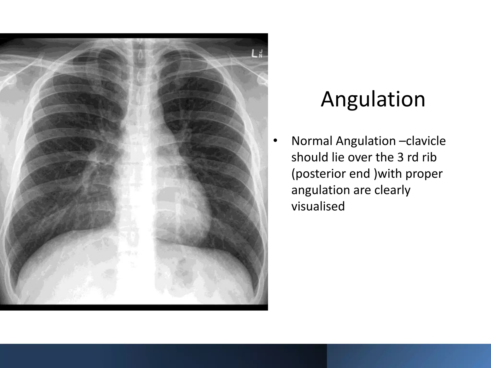 Interpretation of chest xray ppt | PPTX