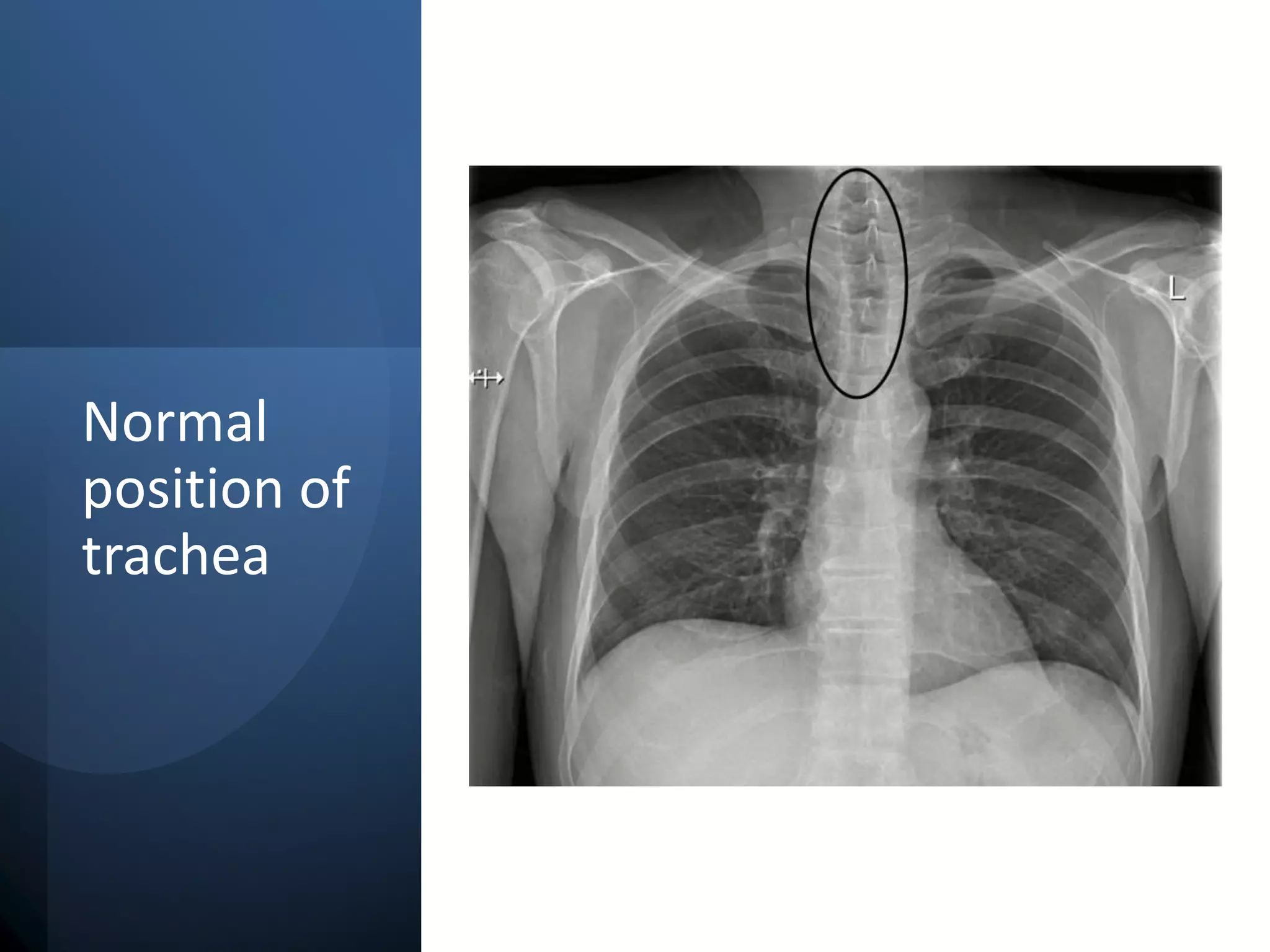 Interpretation of chest xray ppt | PPTX