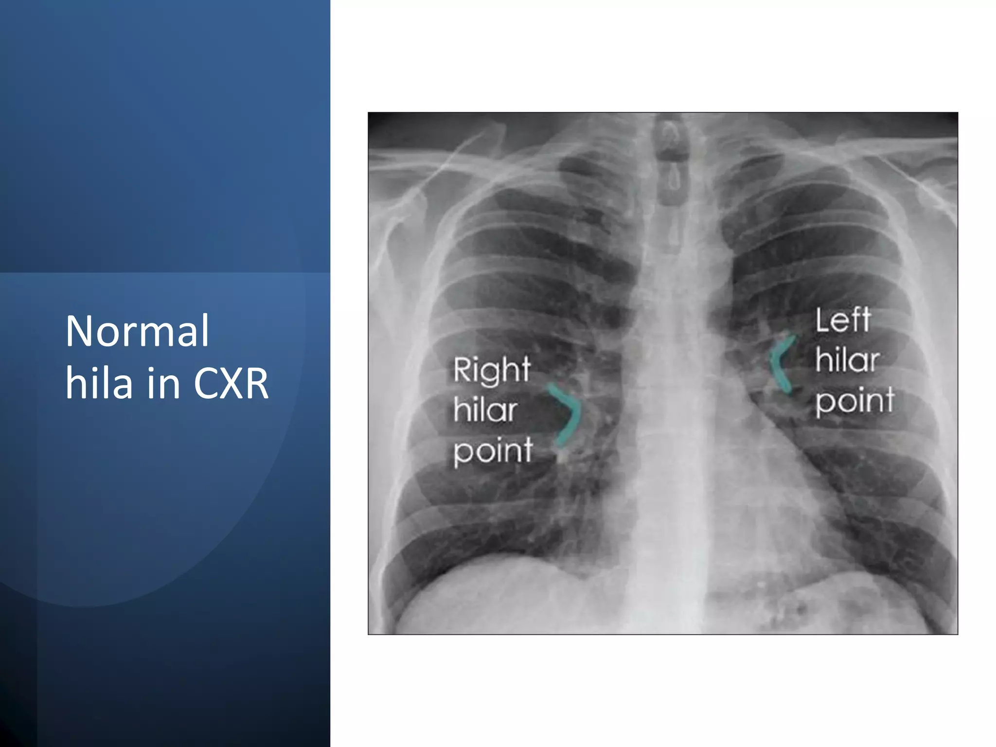 Interpretation of chest xray ppt | PPTX