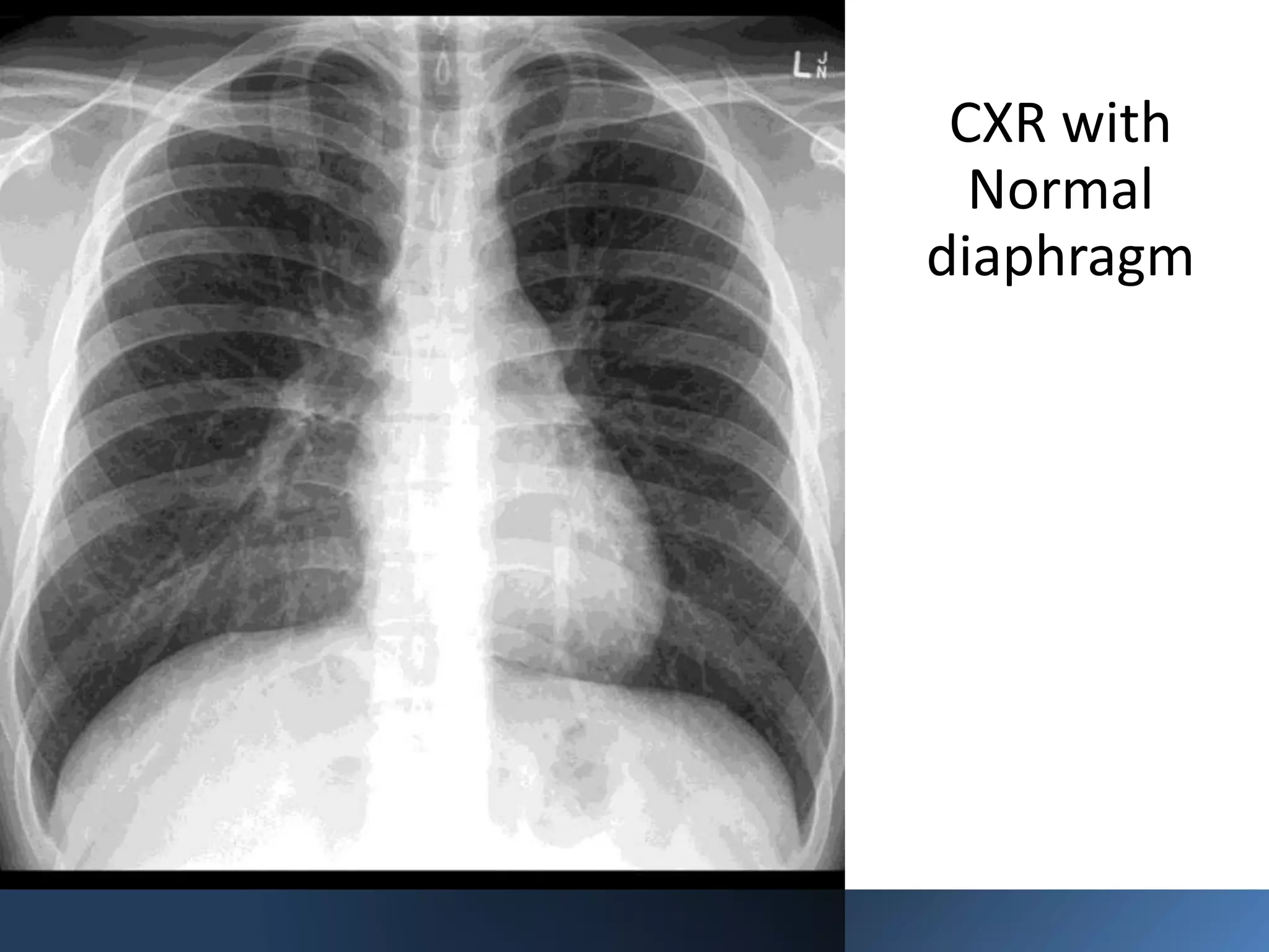 Interpretation of chest xray ppt | PPTX