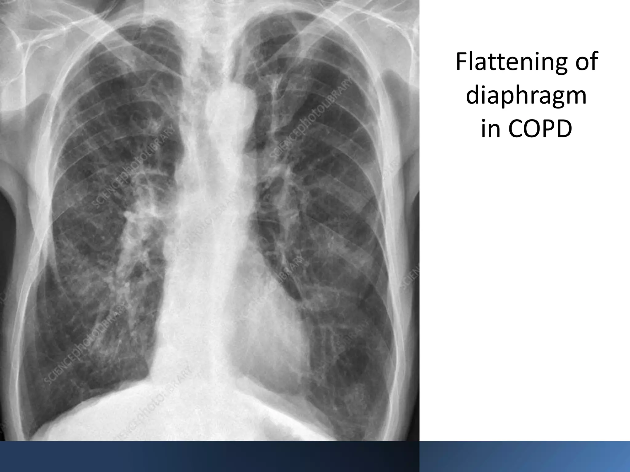 Interpretation of chest xray ppt | PPTX