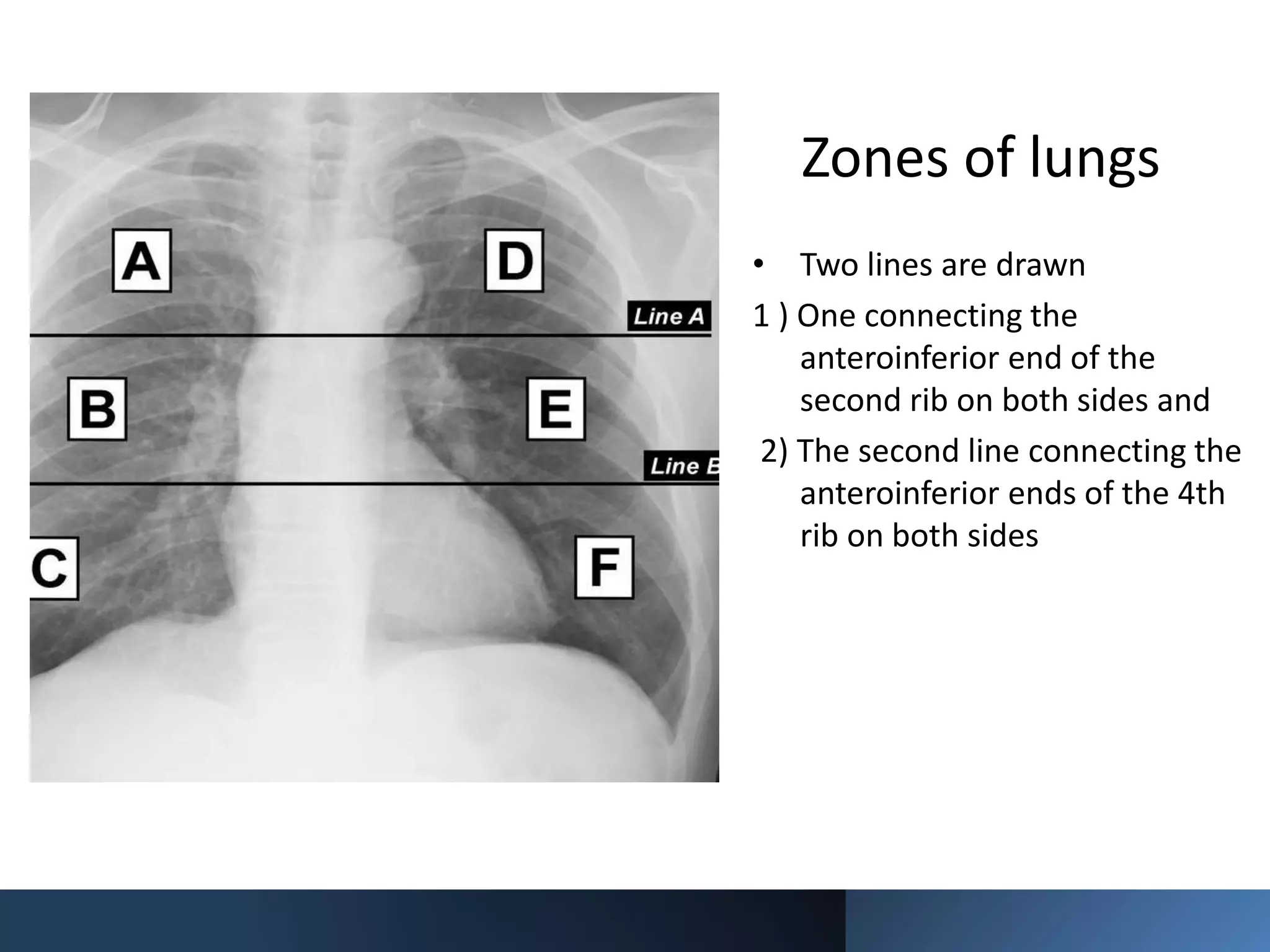 Interpretation of chest xray ppt | PPTX