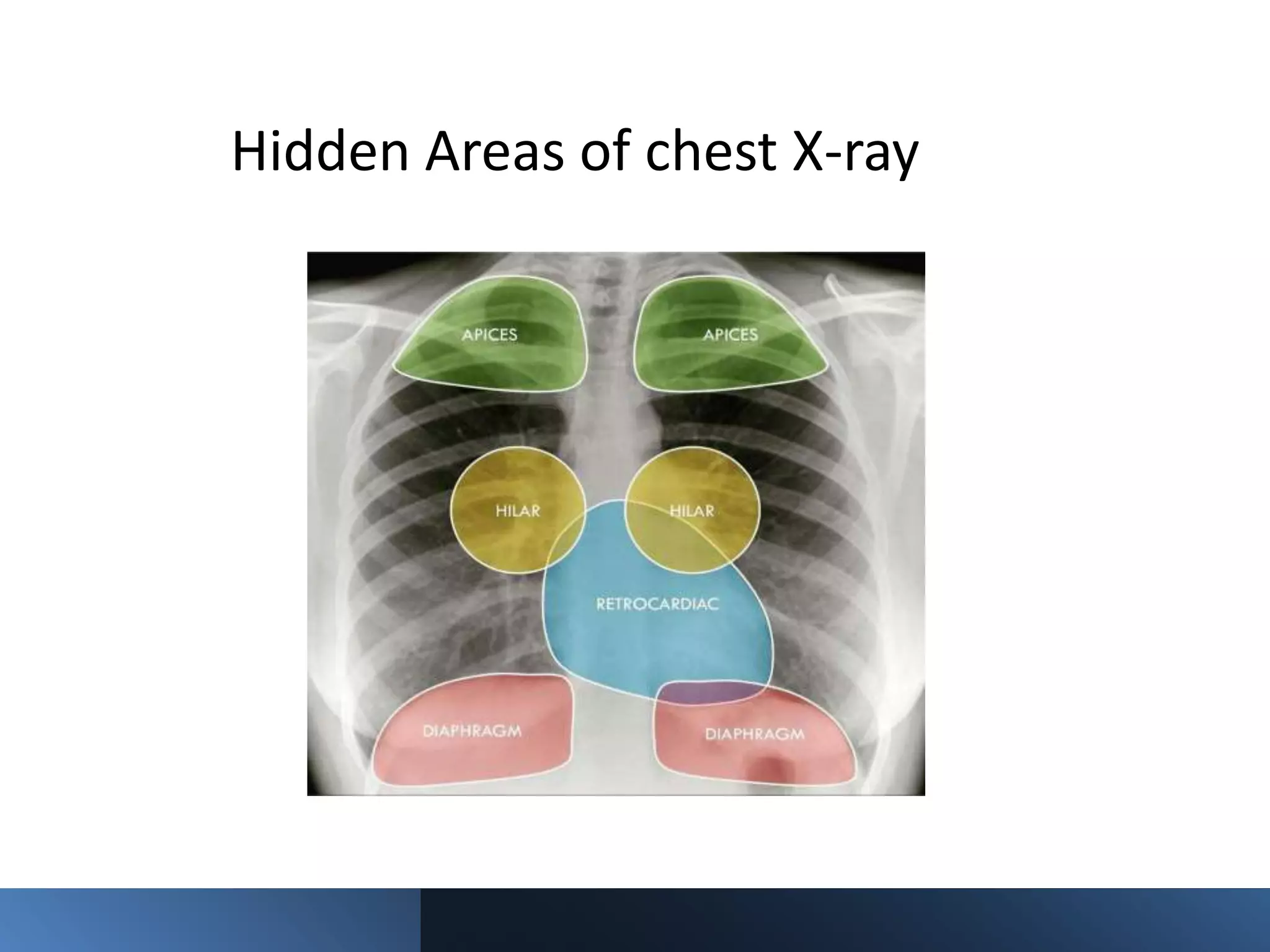 Interpretation of chest xray ppt | PPTX