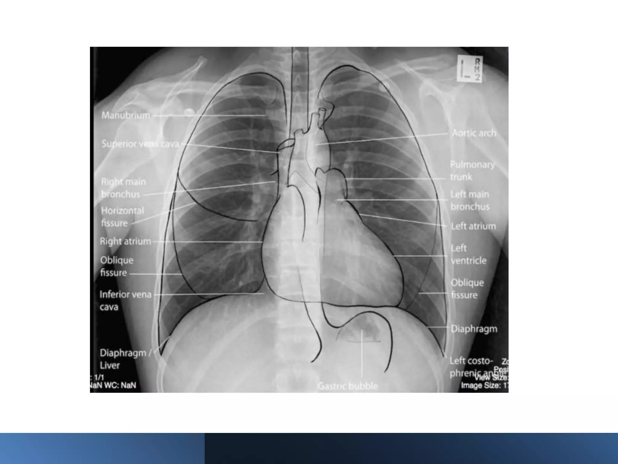 Interpretation of chest xray ppt | PPTX