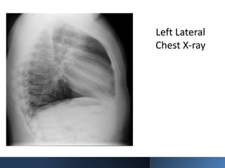 Interpretation of chest xray ppt | PPTX