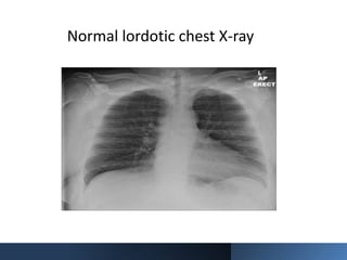 Interpretation of chest xray ppt | PPTX