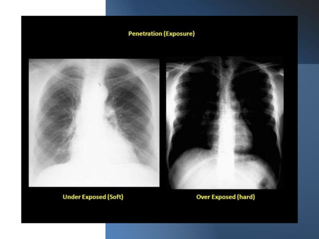 Interpretation of chest xray ppt | PPTX