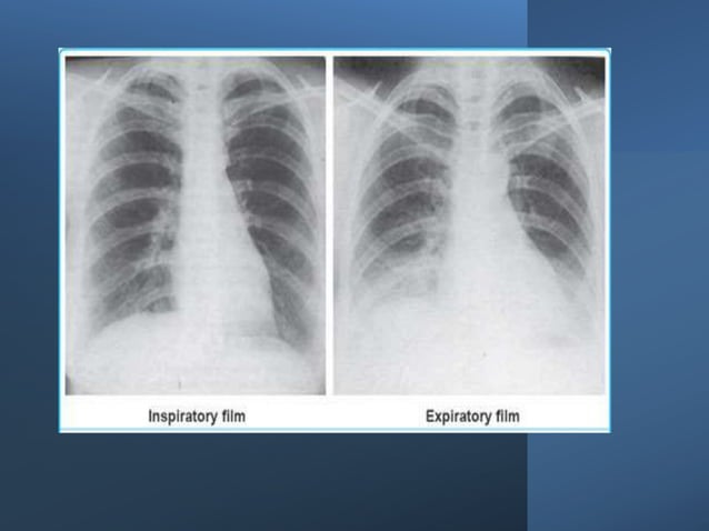 Interpretation of chest xray ppt | PPTX