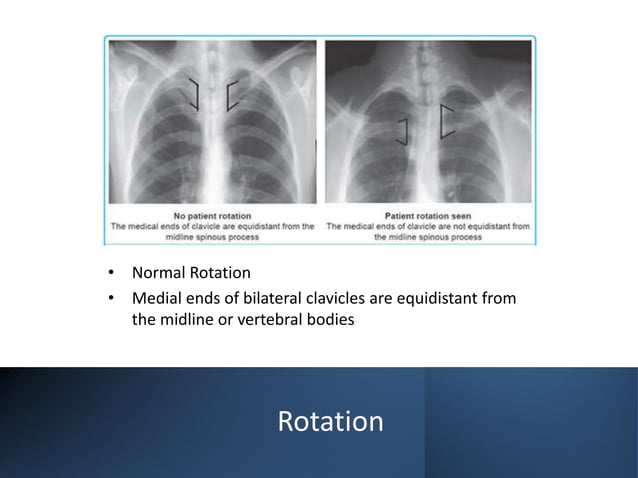 Interpretation of chest xray ppt | PPTX