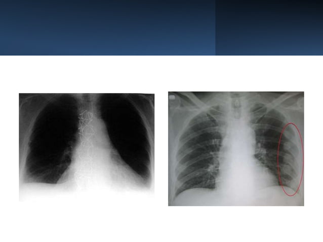 Interpretation of chest xray ppt | PPTX