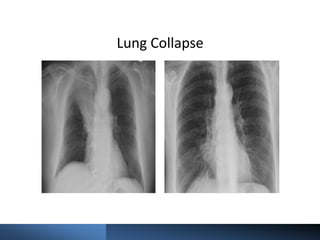 Interpretation of chest xray ppt | PPTX