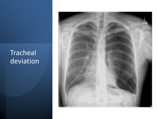 Tracheal Deviation X Ray