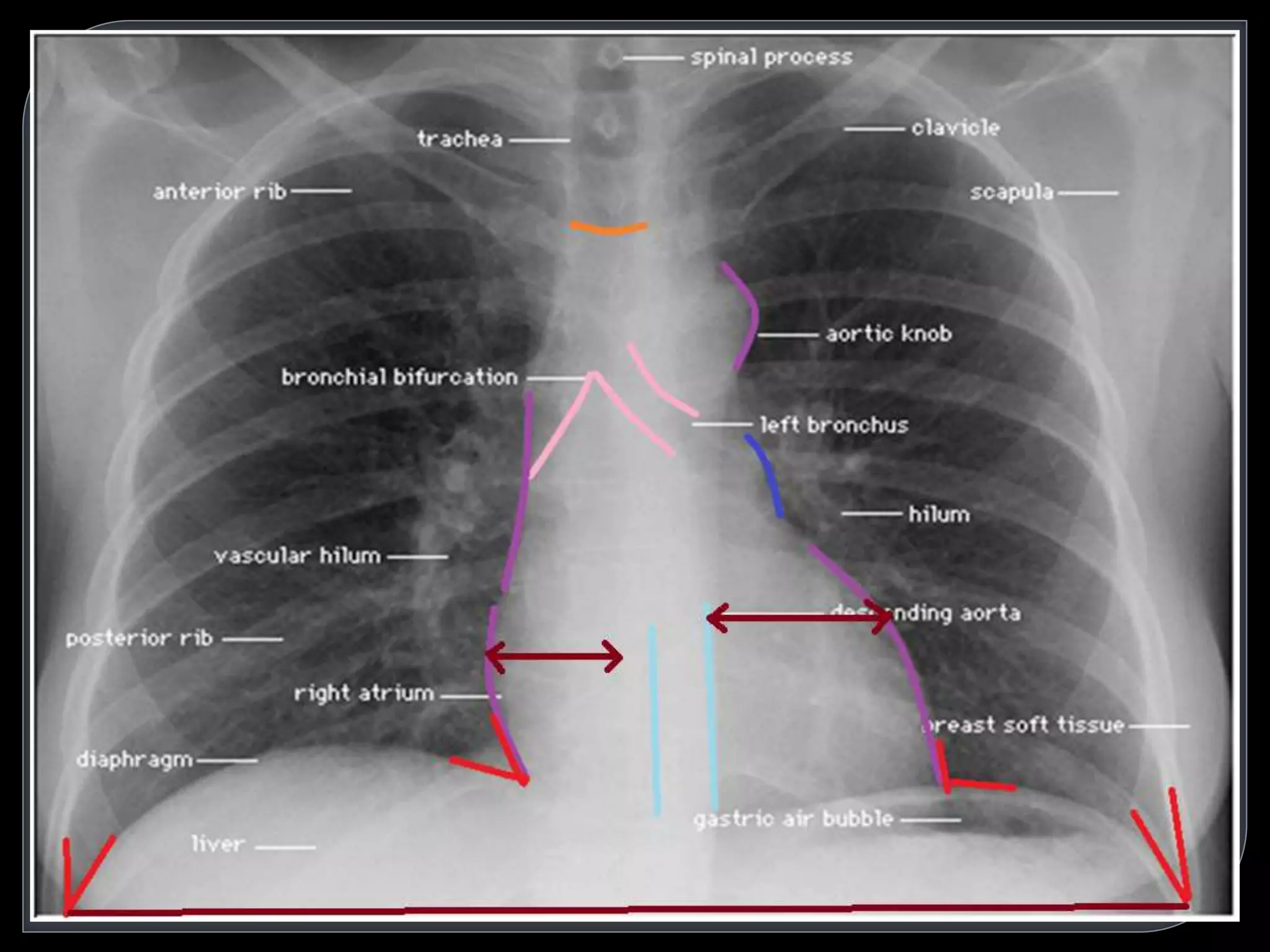 Interpretation of chest x-rays | PPTX