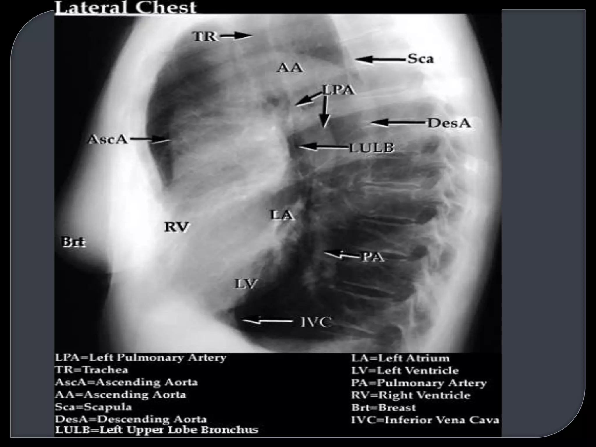 Interpretation of chest x-rays | PPTX