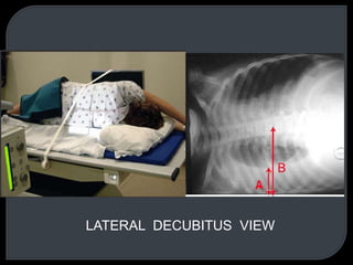 Interpretation of chest x-rays | PPTX