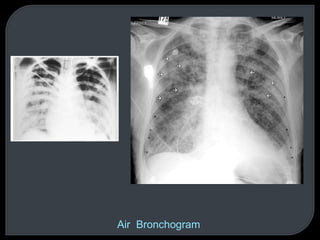 Interpretation of chest x-rays | PPTX